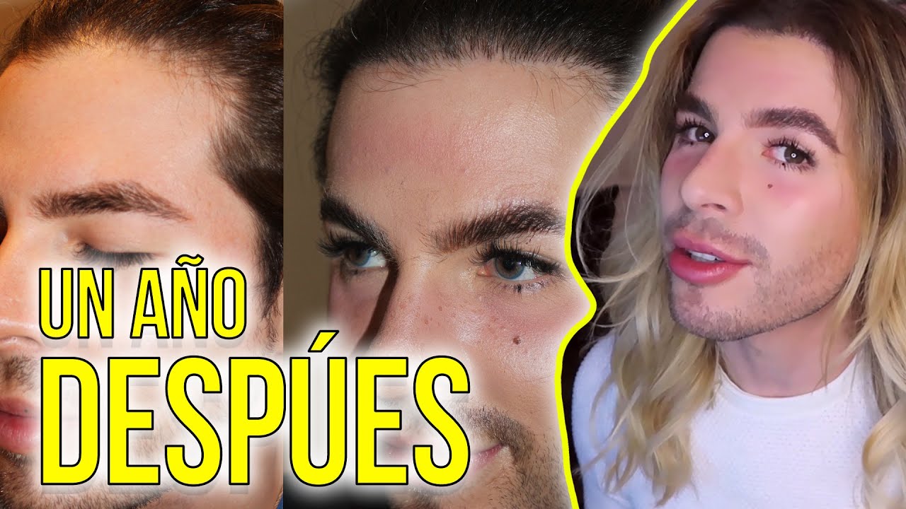 Mi trasplante de cabello UN AÑO DESPÚES Fotografías resultados| David ...