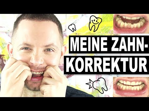 GERADE ZÄHNE MIT DER HARMONIESCHIENE, Invisalign, Dr Smile 1/4 – GREY YOUNG