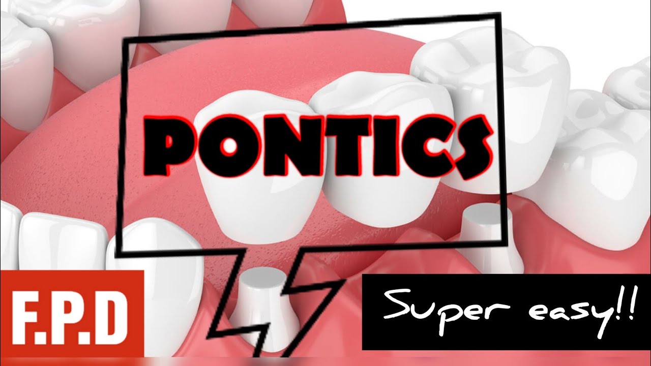 Pontic | Fixed Partial Denture | Prosthodontics | Just 5 Minutes | FPD ...