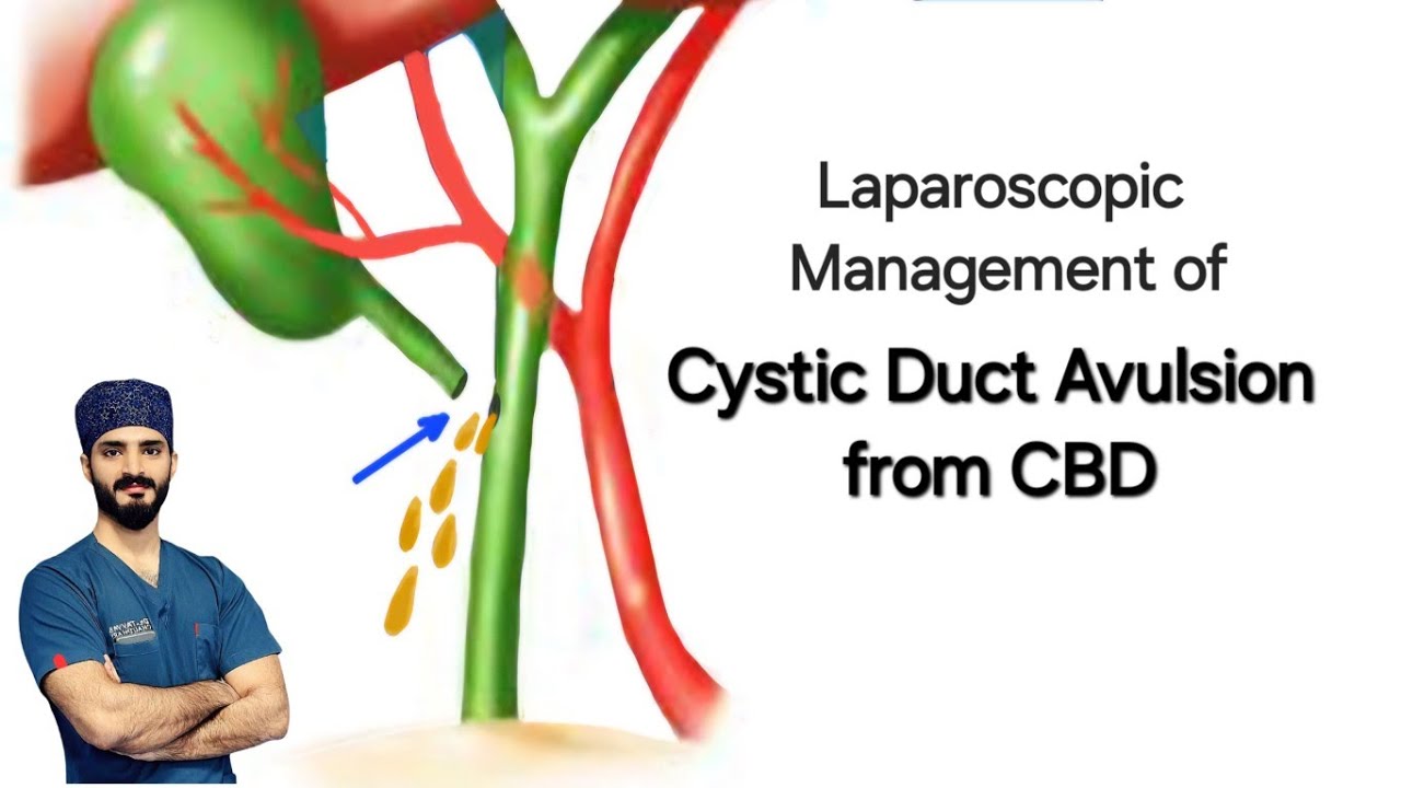 Management of Cystic Duct Avulsion from CBD during Lapchole - Dr Tayyab ...