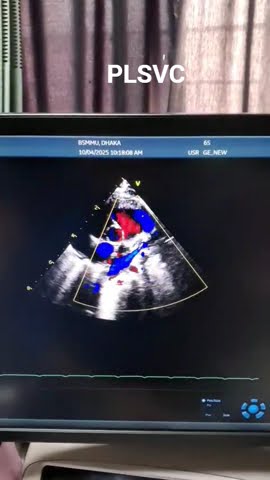 Echo//Echocardiography //Echo of the Children //Baby Echocardiogram ...