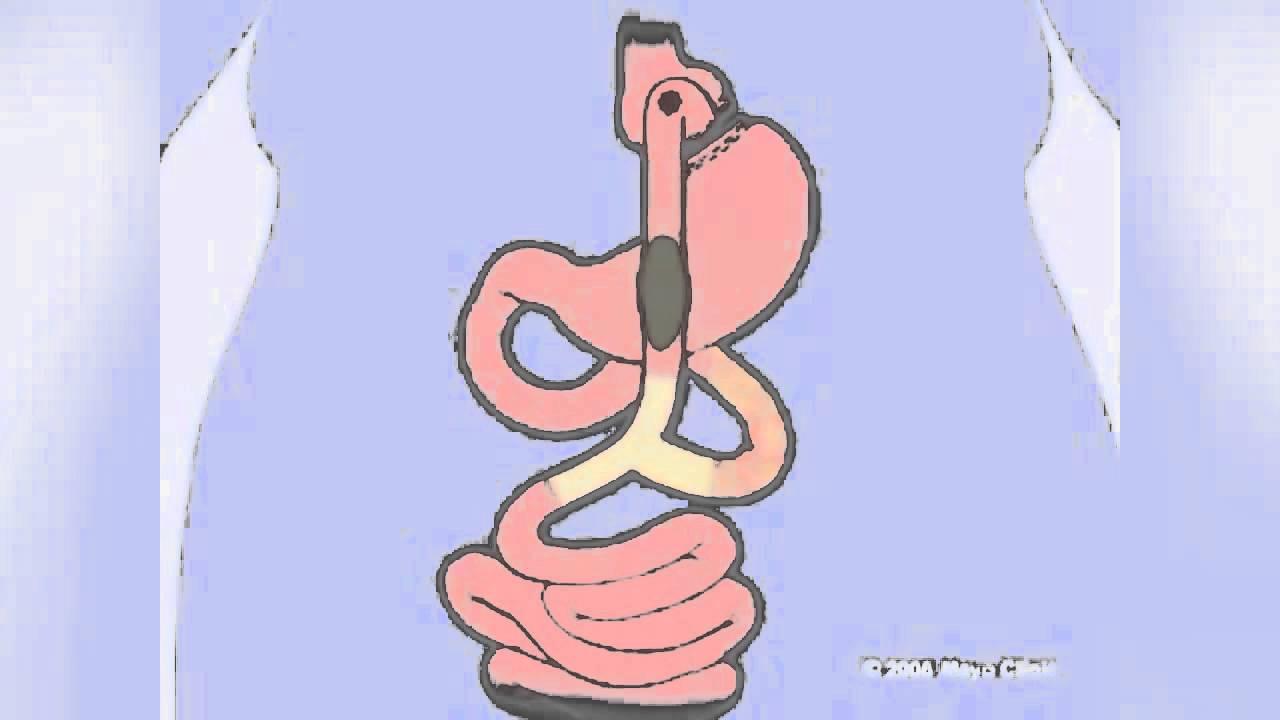 Bariatric Surgery - 3 Different Weight Loss Surgery - YouTube
