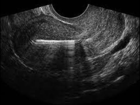Ultrasonographic assessment of IUD position. - YouTube