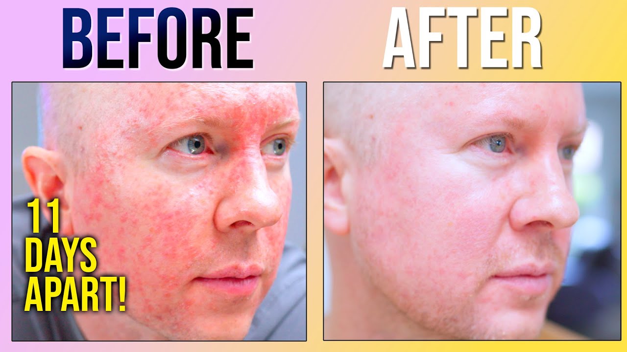 Face Flare-Up? This Skincare Routine Treated My Red Bumpy Face FAST ...