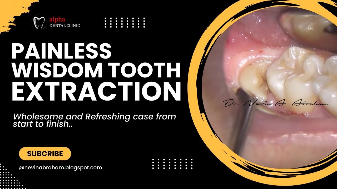 Painless 3rd molar (Wisdom tooth) extraction - YouTube