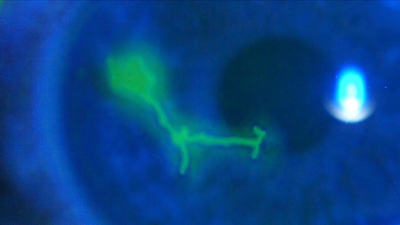 Clínica de las queratitis herpéticas dendrítica y geográfica - YouTube
