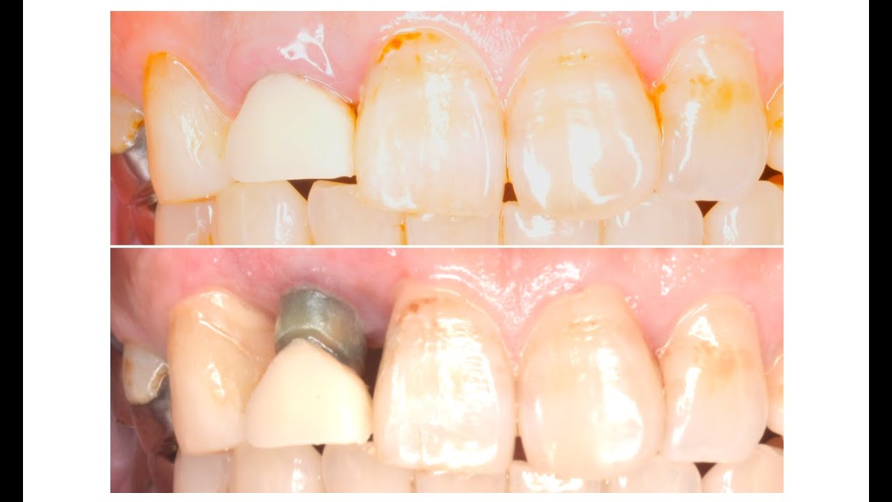 Apically positioned flap for upper lateral incisor - YouTube