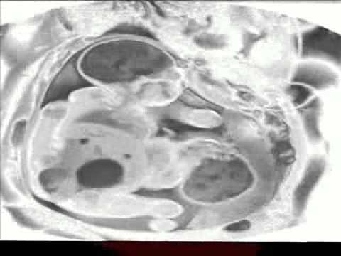 MRI inversion volume of conjoined twins in the womb - YouTube