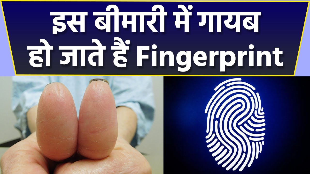 Adermatoglyphia क्या है, इस बीमारी में Fingerprint क्यों हो जाते हैं ...