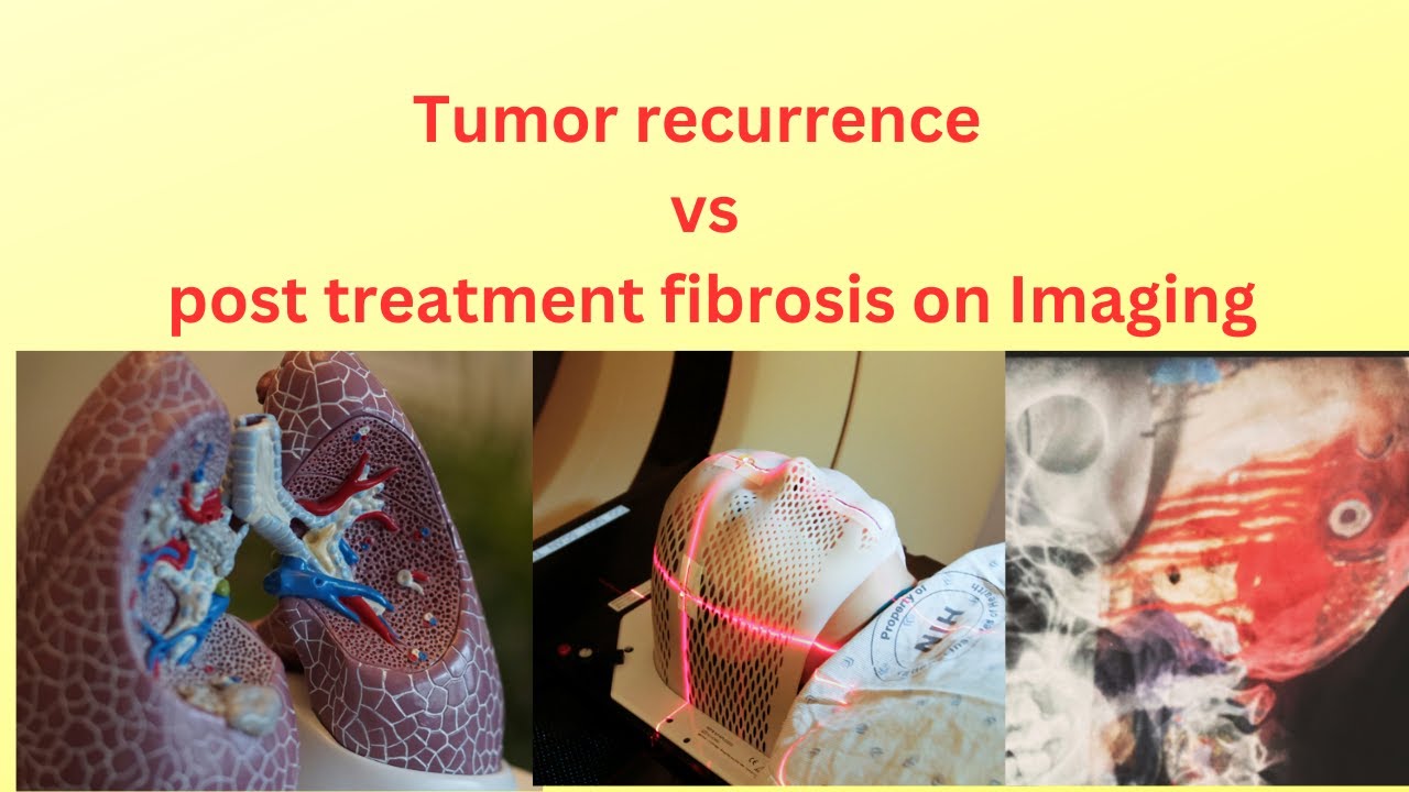 Tumor recurrence vs Post treatment fibrosis - YouTube