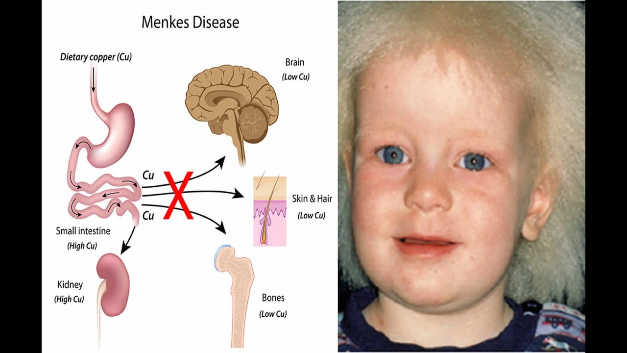Copper Transport Disorder: What You Need to Know About Menkes Syndrome ...