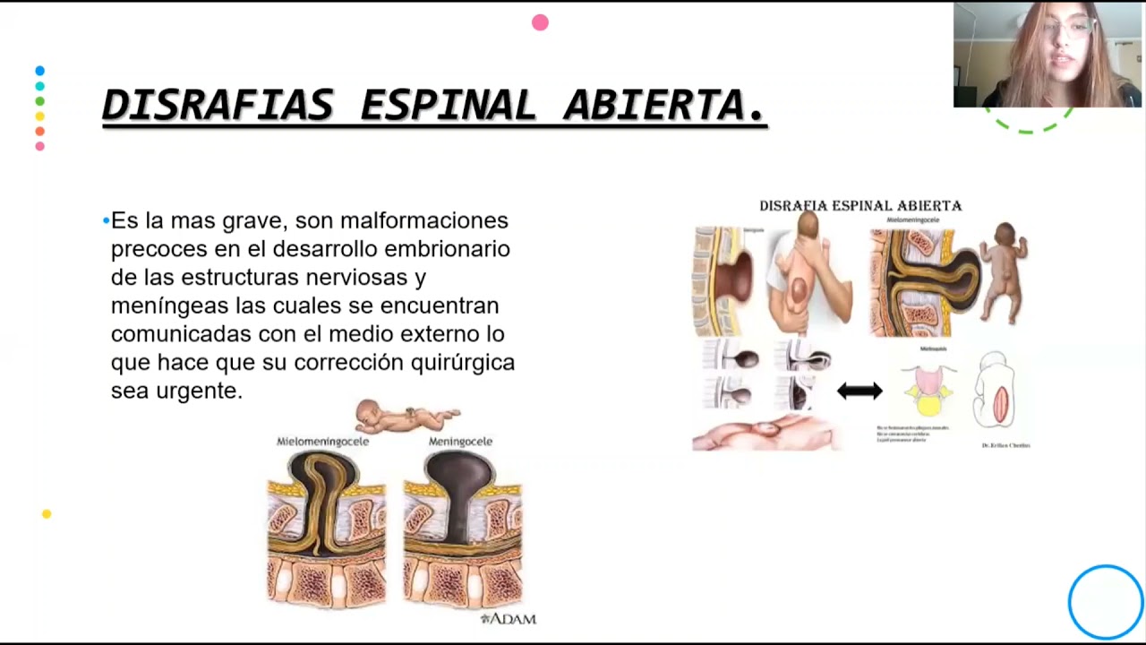 disrafias espinales - YouTube