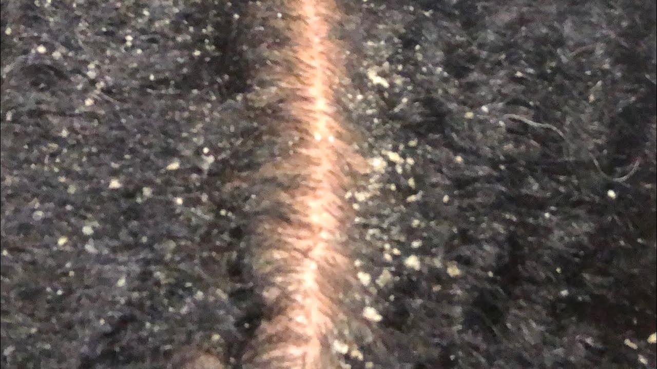 Dandruff Scratching Asmr Youtube
