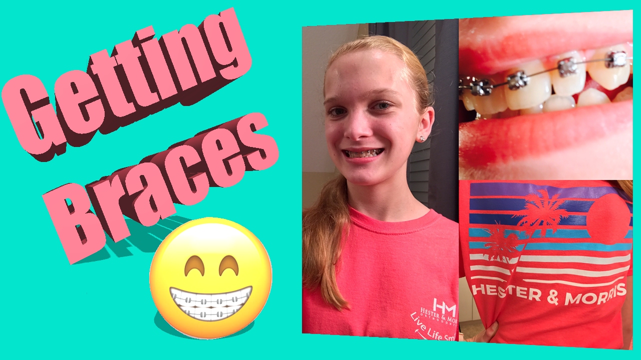 Getting Braces - YouTube