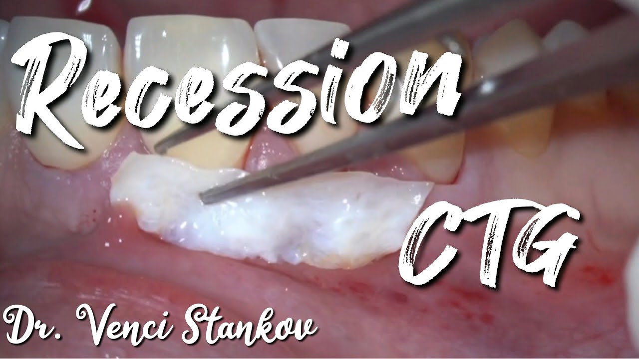 Gum recession surgery treatment. Dr. Venci Stankov - YouTube