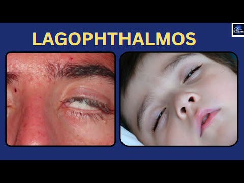 What is LAGOPHTHALMOS | explained sign causes @eyecareoptom5506 - YouTube
