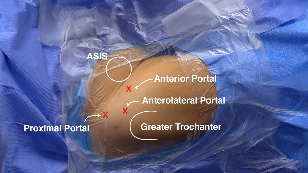Arthroscopic Technique for Excision of Hip Heterotopic Ossification (HO ...