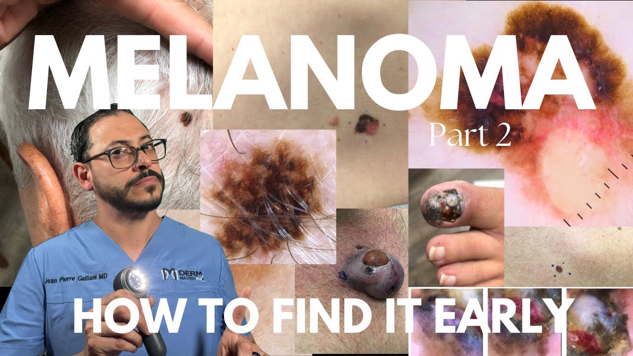 Melanoma Part 2: How to find melanoma early - YouTube