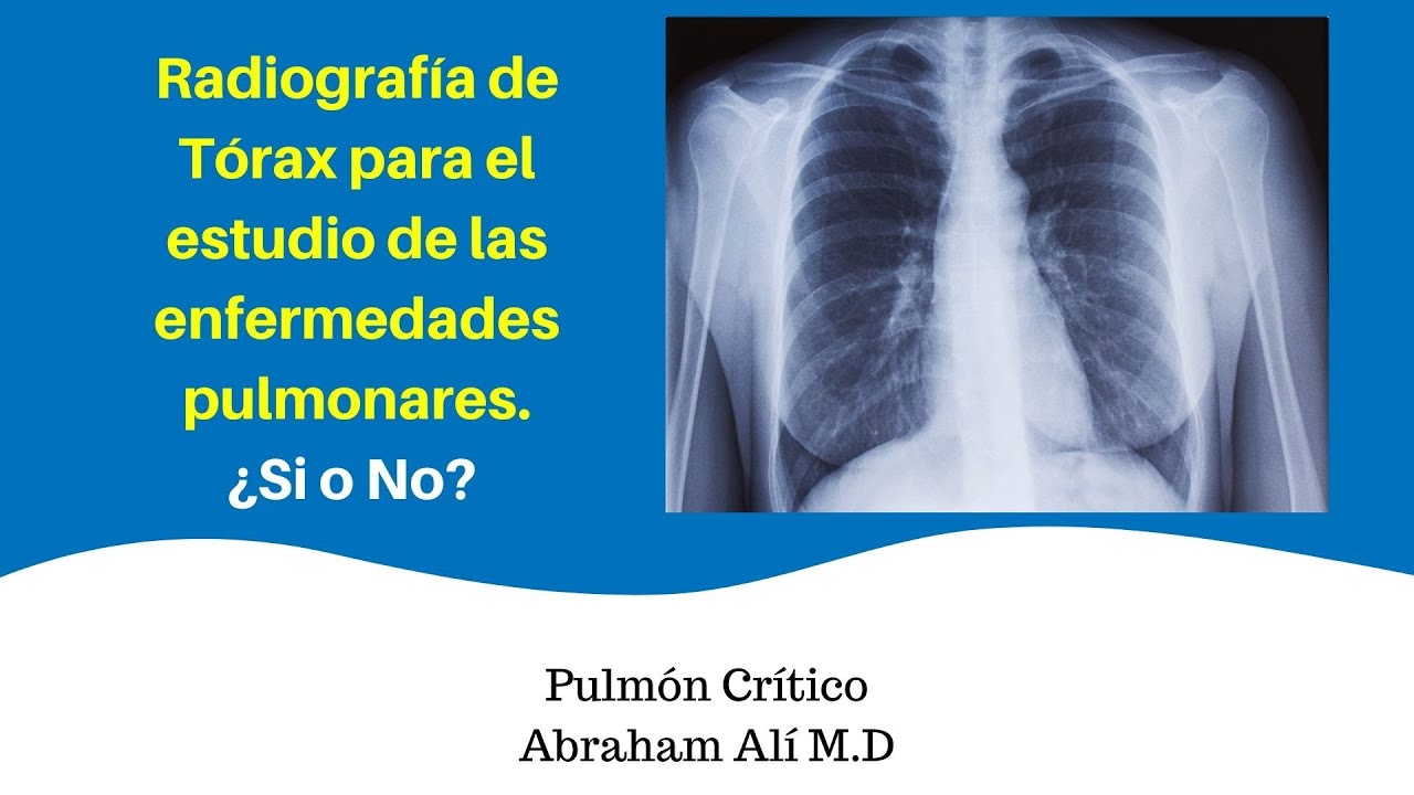 Radiografía de tórax en enfermedades pulmonares - YouTube