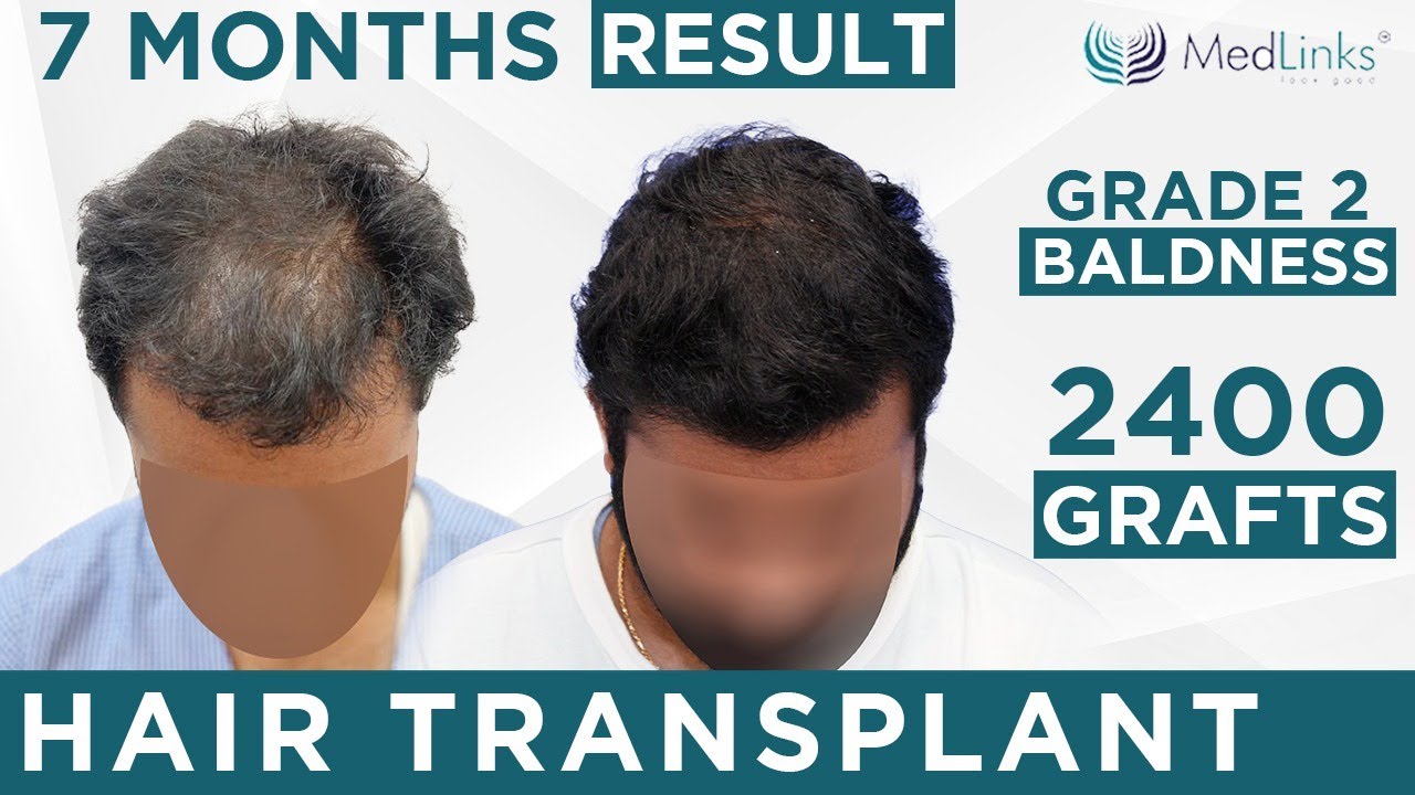 Before and After Hair Transplant Results | Treatment of Grade 2 ...
