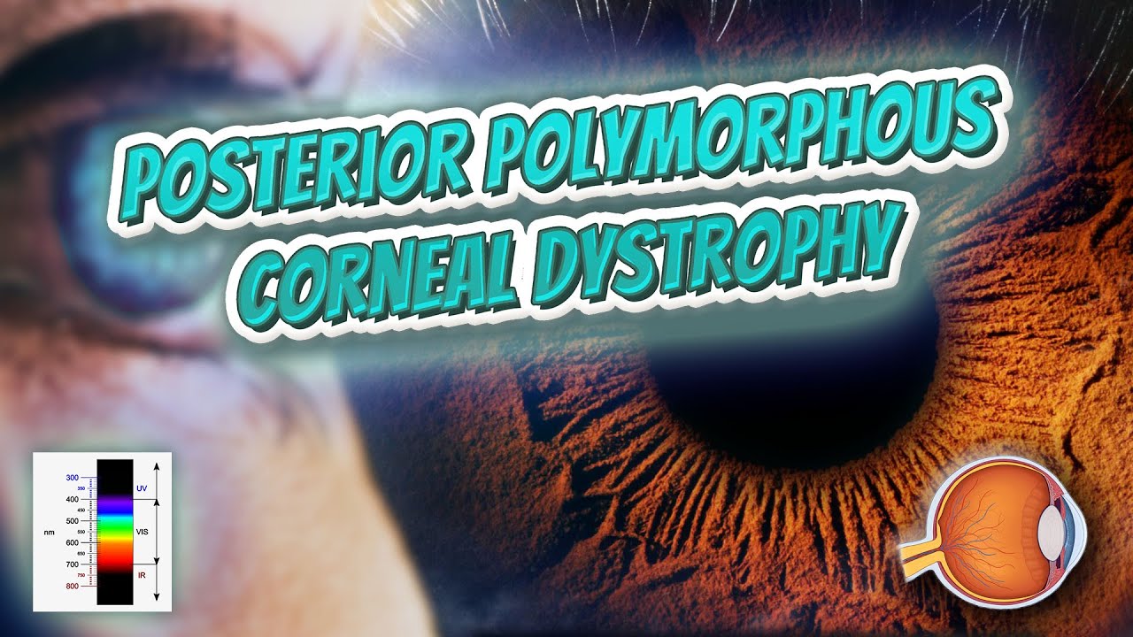 Posterior polymorphous corneal dystrophy - Your EYEBALLS - EYNTK 👁️👁️💉😳 ...