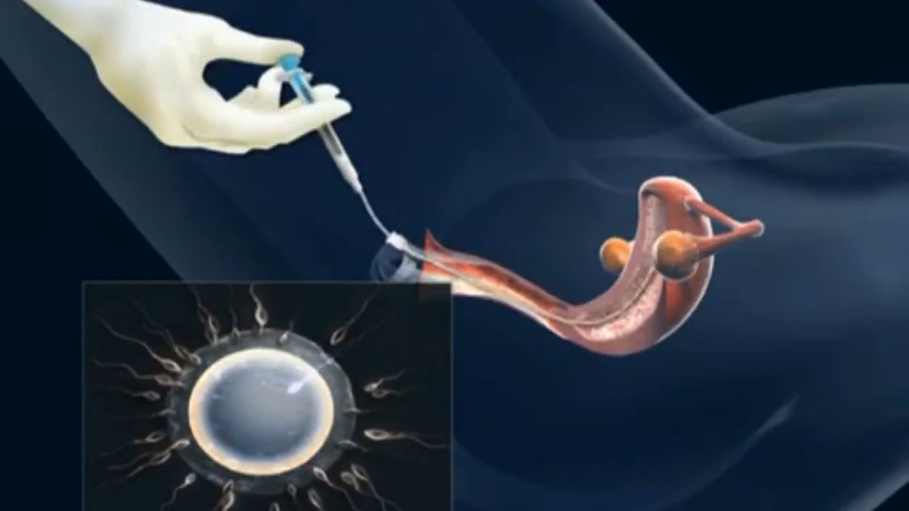 Proceso de la Inseminación Intrauterina - YouTube