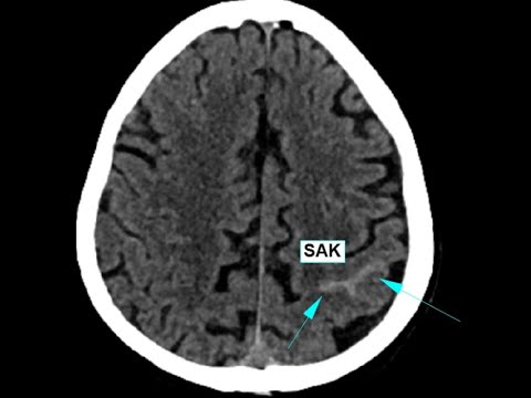 İntrakraniyal kanamalar part1  epidural, subdural, SAK