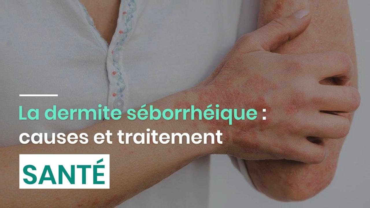 La dermite séborrhéique : causes et traitement - YouTube