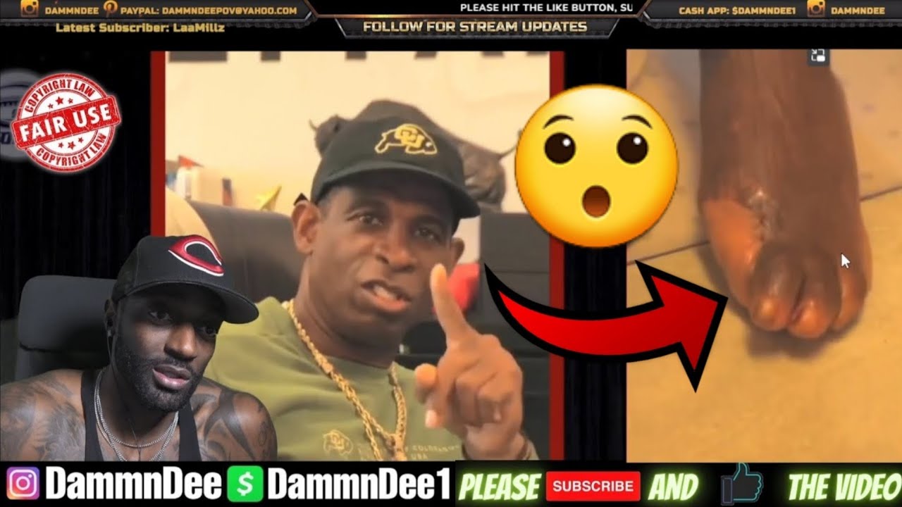 OMG!! Deion Sanders Shows His Life-Threatening Amputated Toes After ... OMG!! Deion Sanders Shows His Life-Threatening Amputated Toes After ...