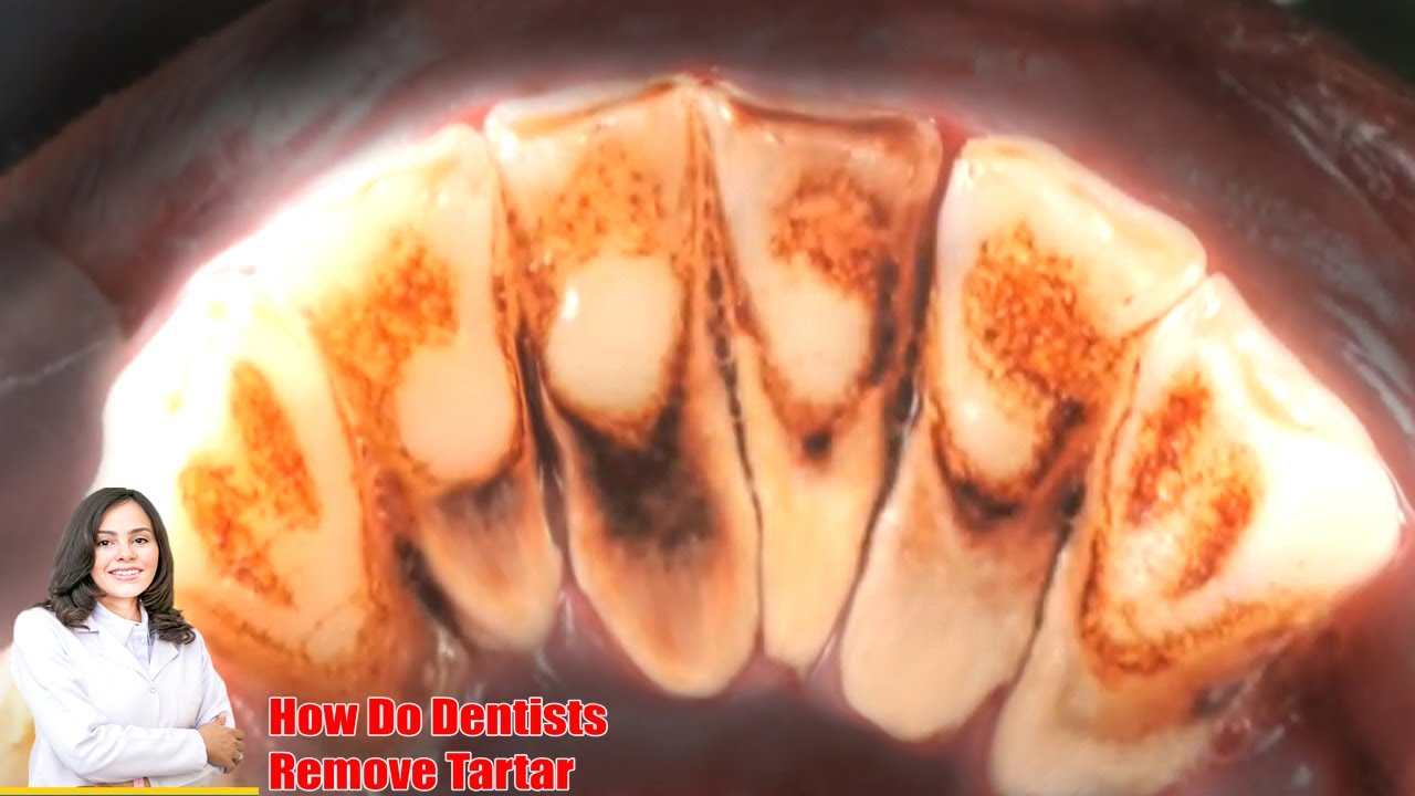 Scaling 28yo. FEMALE Tartar Removal Giant Tartar! tartar removal from ...
