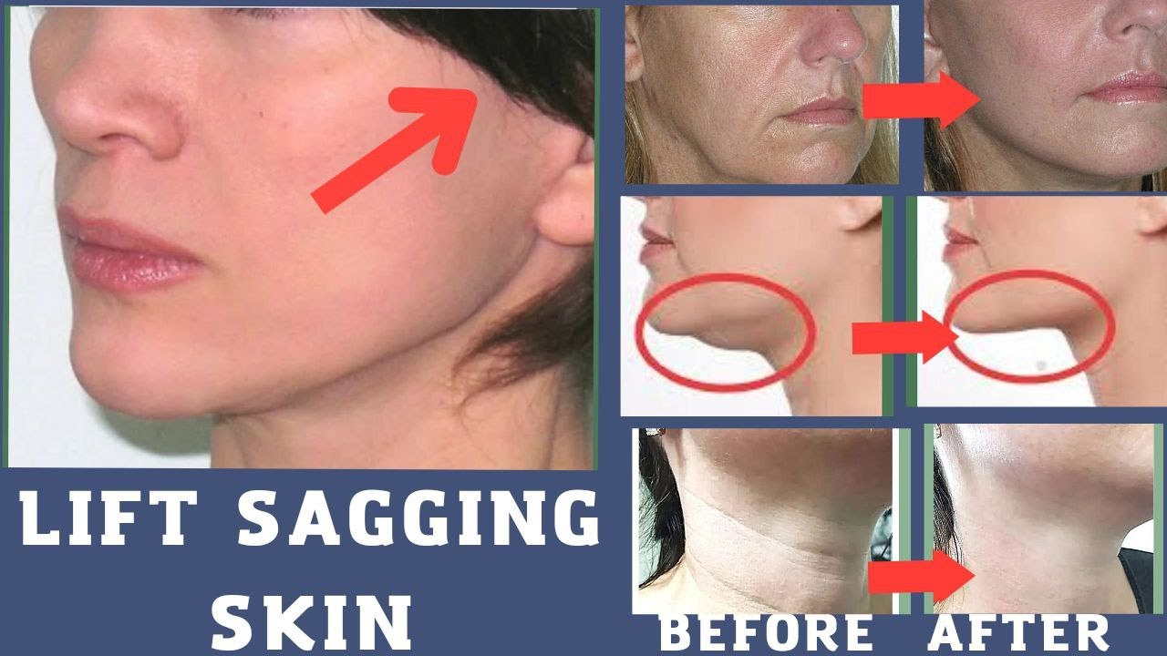 How to Lift Sagging Skin ? Reduce Smile Lines | Marionette |Jawline ...