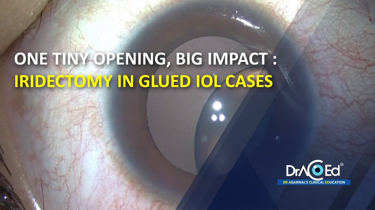 33 | One Tiny Opening, Big Impact : Iridectomy in Glued IOL Cases - YouTube