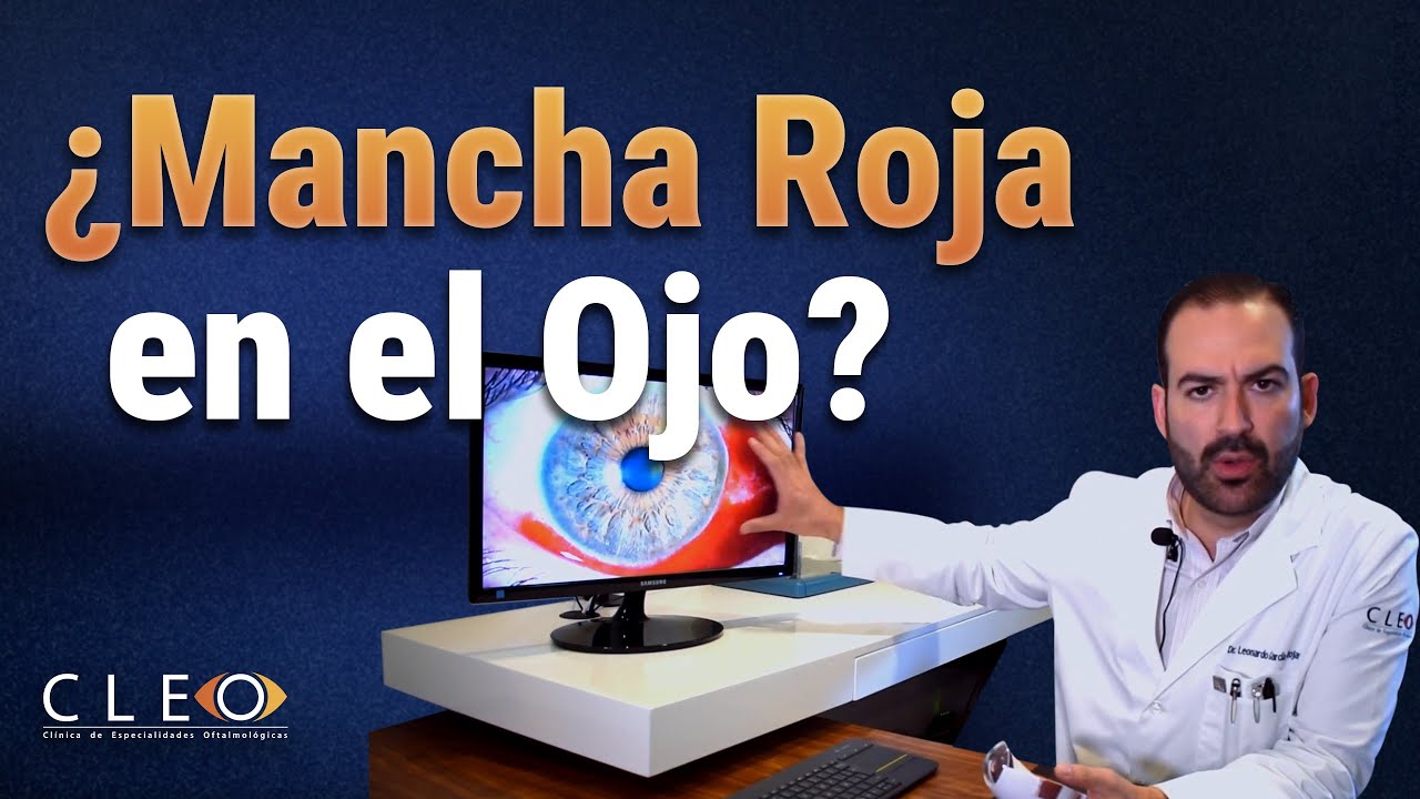 🔴 ¿Qué es la Hemorragia Subconjuntival? 🔍 Causas, Síntomas y ...