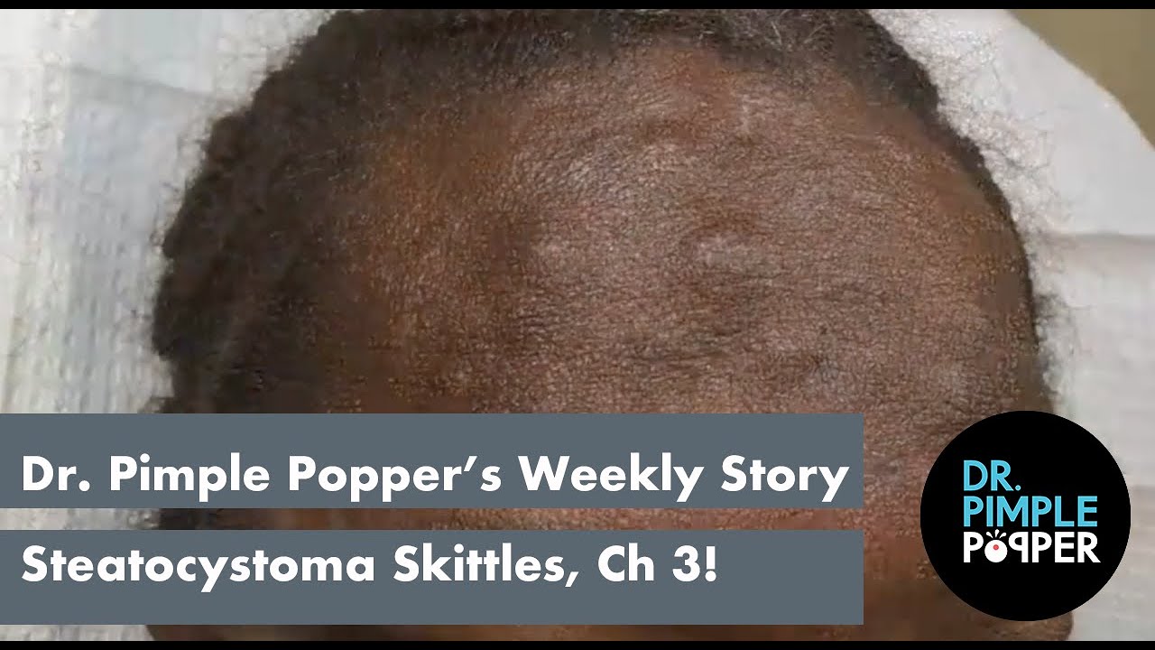 Dr. Pimple Popper's Weekly Story Time: Steatocystoma Skittles, Chapter ...
