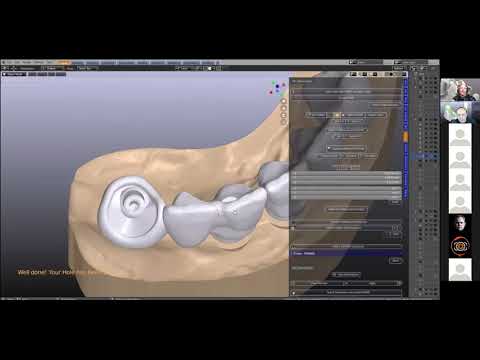 ZOOM- B4D Crown Module... Implants, Implants - YouTube