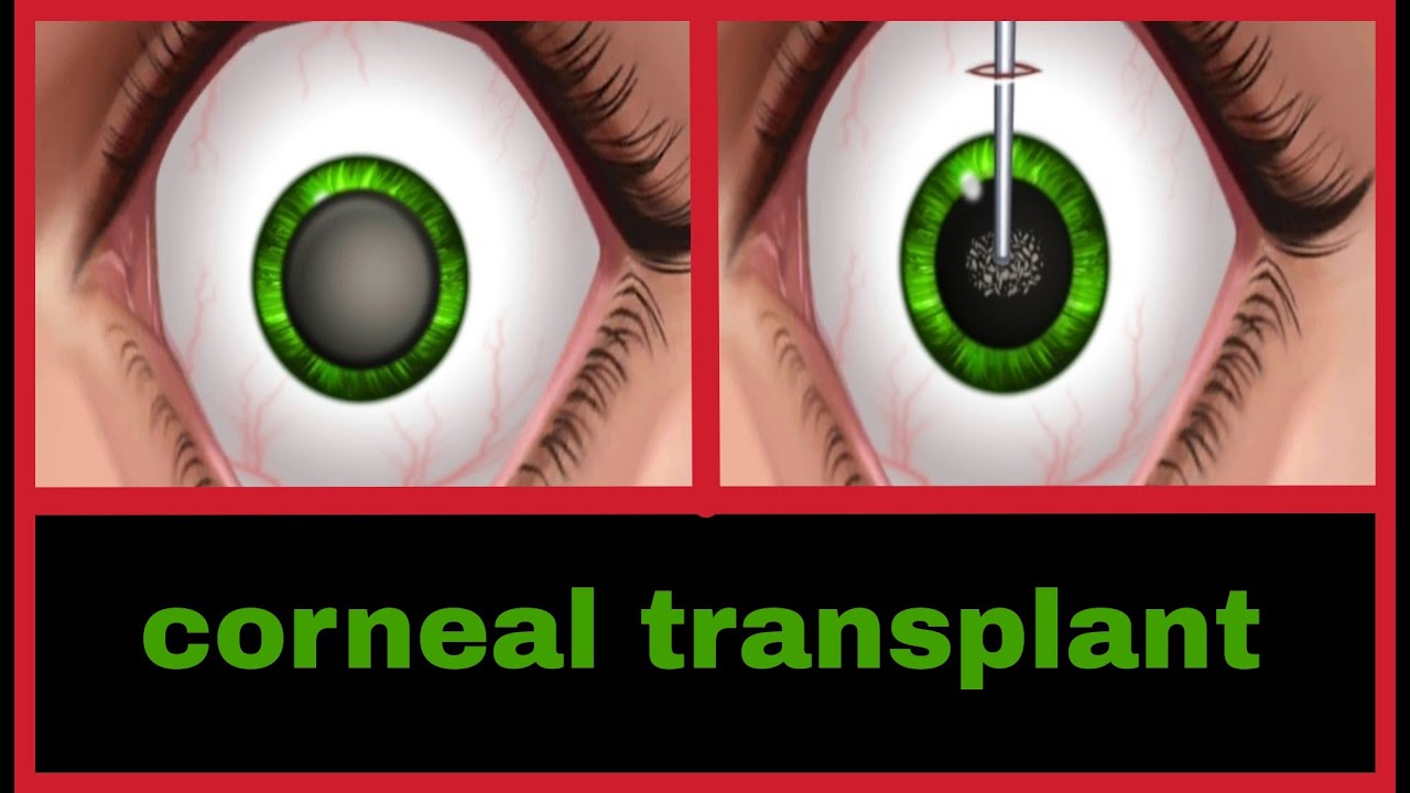 ASMR corneal transplant surgery animation video - YouTube