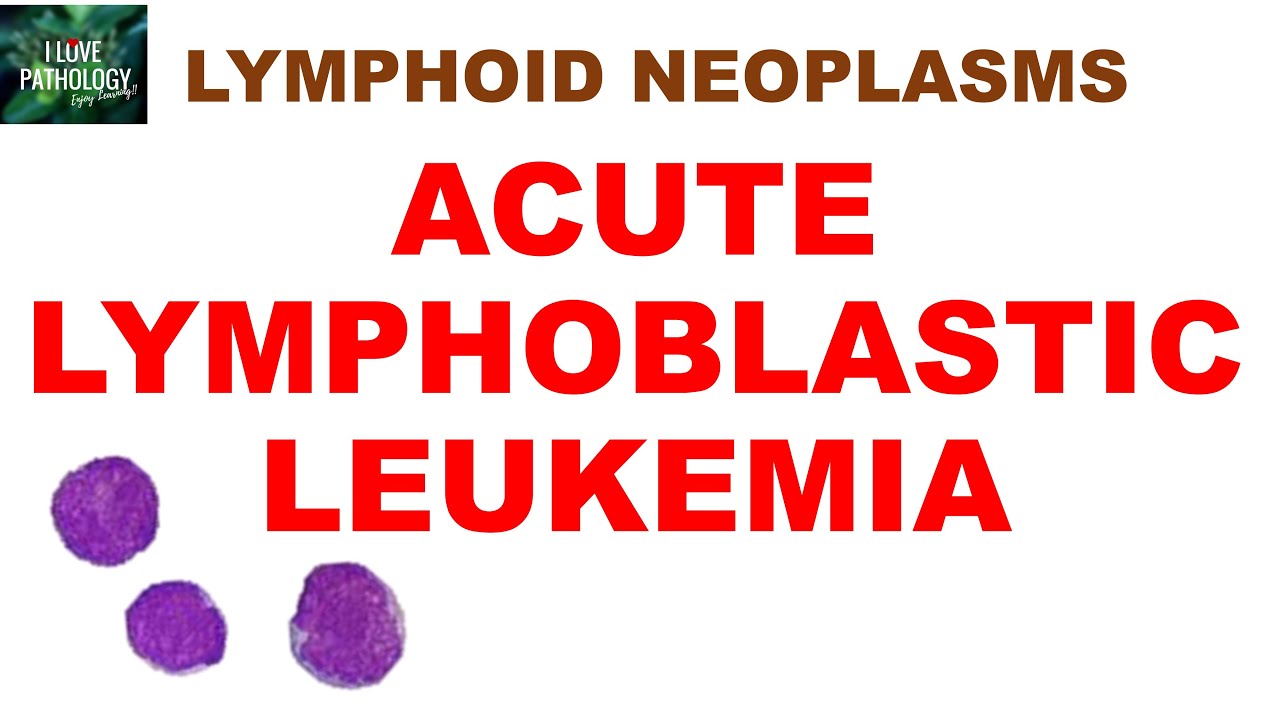 Acute Lymphoblastic Leukemia (ALL) – Epidemiology, Pathogenesis ...