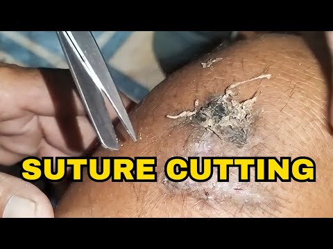 suture cutting | टांके केसे कांटे | how to cut sutures - YouTube