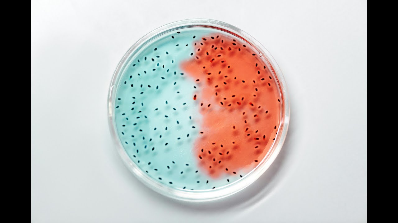 MPO-ANCA Positivity in IgA Nephropathy: Deceptor or Consequence? - YouTube