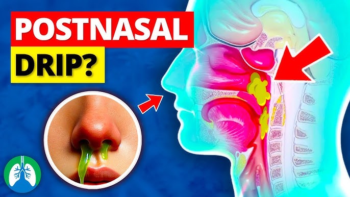 Drip Post Nasal