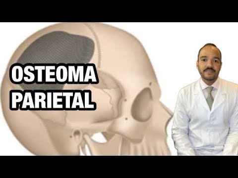 OSTEOMA: OSSO PARIETAL - YouTube