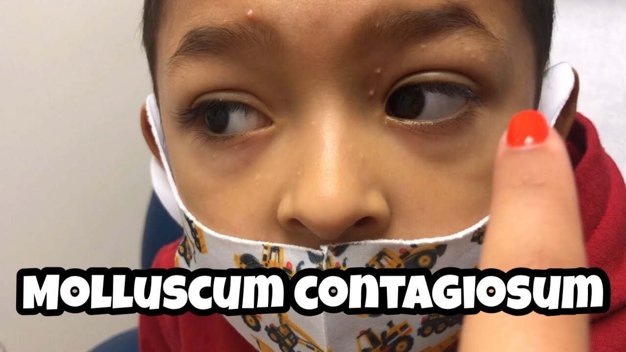 My kid has molluscum contagiosum 2020 - YouTube