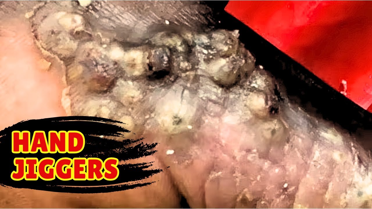 the hidden danger of ignoring hand jiggers🔥 - YouTube