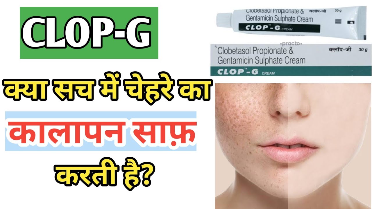 Clop-G Cream Review in hindi. Healthy-Bro. - YouTube