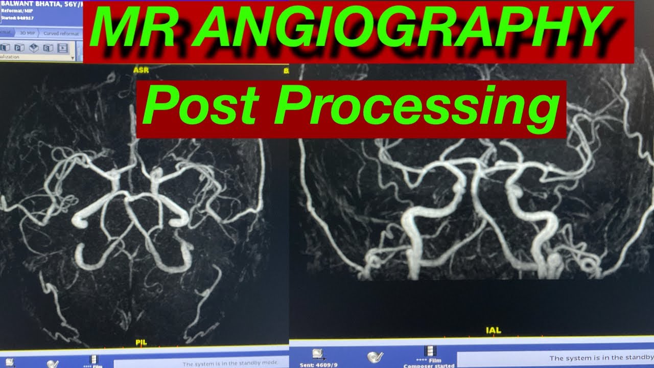 MRI Brain Angiography post processing #MRA post processing #TOF Brain ...
