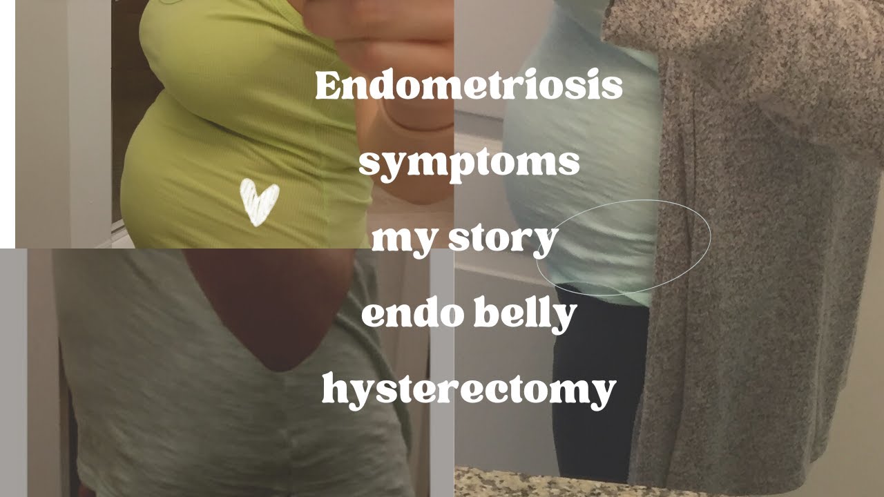 Endometriosis symptoms, diagnosis and treatments. #Hysterectomy ...