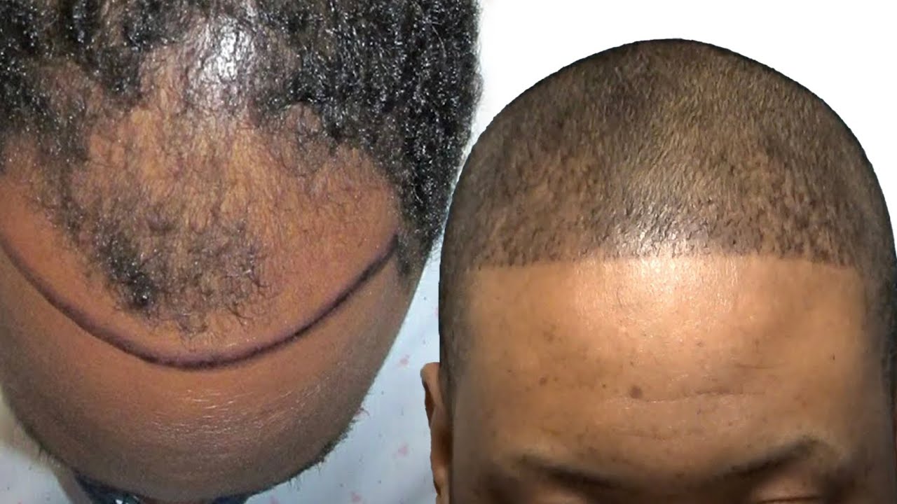 Front Hairline Reconstruction - 8 months later - YouTube