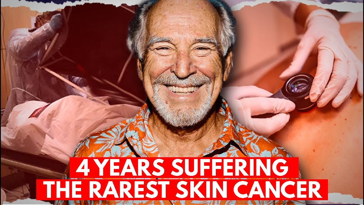 Jimmy Buffett's Rare Disease Merkel Cell Cancer - YouTube