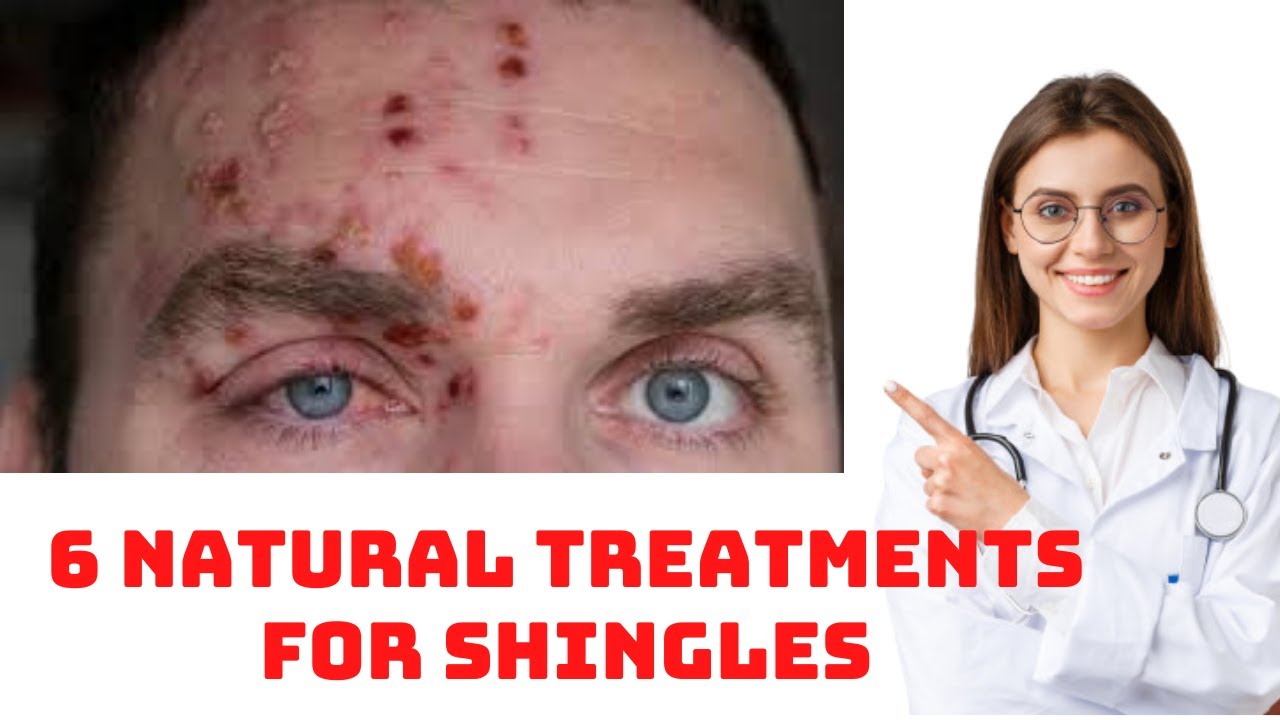 How To Treat Shingles - 6 Natural Treatments for Shingles - YouTube