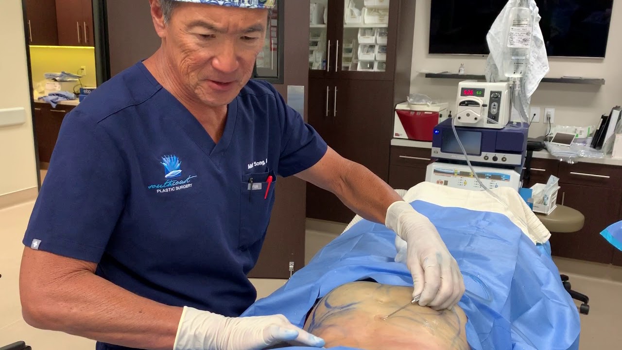 Microcannula Tumescent Liposuction Procedure - YouTube
